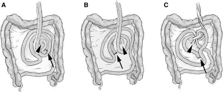 Hooking intestine sign: a typical diagnostic CT finding of Petersen’s ...