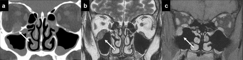 Imaging features of benign mass lesions in the nasal cavity and ...