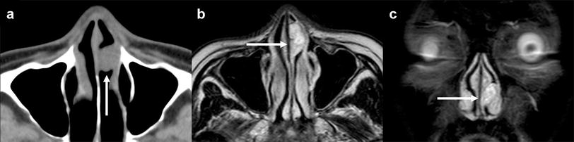 Imaging features of benign mass lesions in the nasal cavity and ...