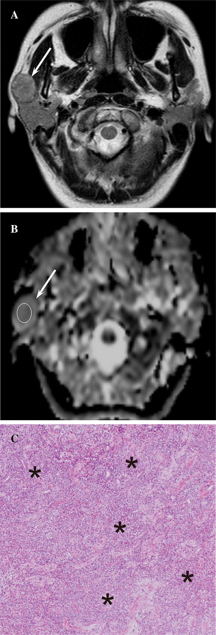 Pleomorphic adenoma of salivary glands: common and uncommon CT and MR ...
