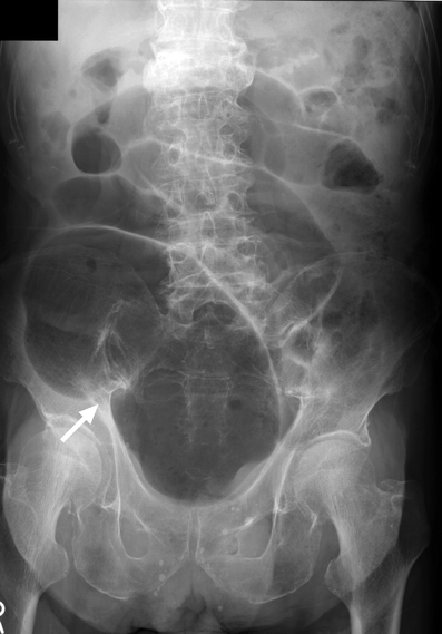 Successful Preoperative Diagnosis of a Rare Bowel Obstruction: Cecal ...