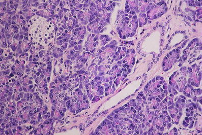 Inverted Meckel’s Diverticulum with Ectopic Pancreatic Tissue as a ...