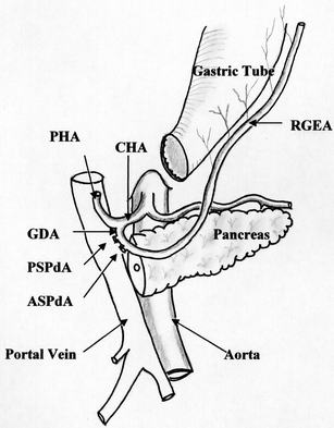 Pylorus-Preserving Pancreaticoduodenectomy after Transhiatal ...