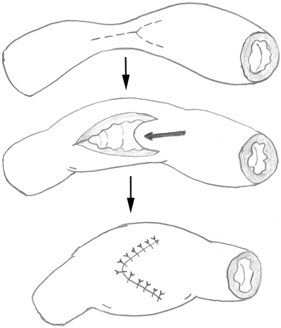A Comprehensive Review of Strictureplasty Techniques in Crohn’s Disease ...