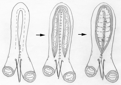 A Comprehensive Review of Strictureplasty Techniques in Crohn’s Disease ...
