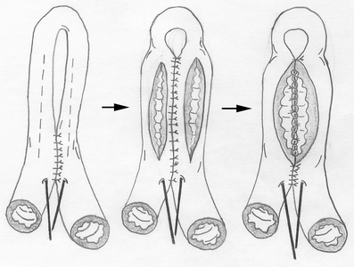 A Comprehensive Review of Strictureplasty Techniques in Crohn’s Disease ...