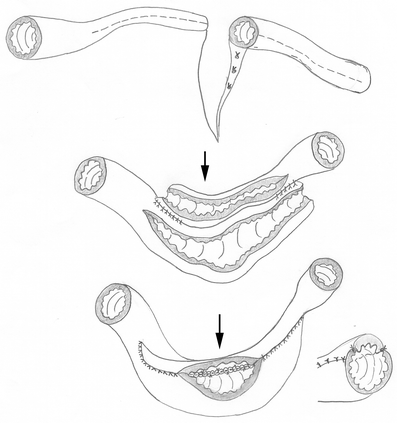 A Comprehensive Review of Strictureplasty Techniques in Crohn’s Disease ...