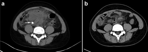 Nonoperative Management of Appendiceal Phlegmon or Abscess with an ...