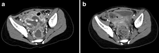 Nonoperative Management of Appendiceal Phlegmon or Abscess with an ...