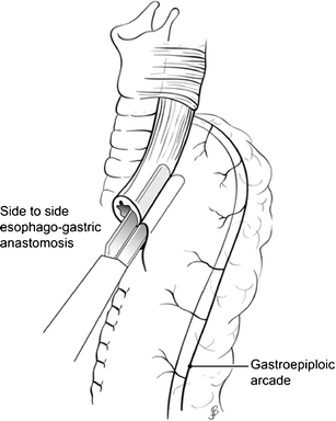 Minimally Invasive Esophagectomy with Extracorporeal Gastric Conduit ...