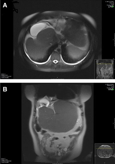 Suprahepatic Gallbladder | SpringerLink