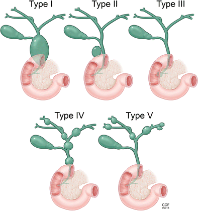 Choledochal Cyst Disease in a Western Center: A 30-Year Experience ...