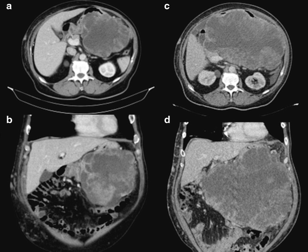 Giant Gastric Gastrointestinal Stromal Tumor (GIST) | SpringerLink