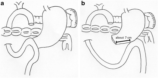 Delayed Gastric Emptying in Side-to-Side Gastrojejunostomy in ...