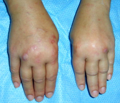 Anorexia Nervosa: Russell’s Sign with Concurrent Tetany | SpringerLink