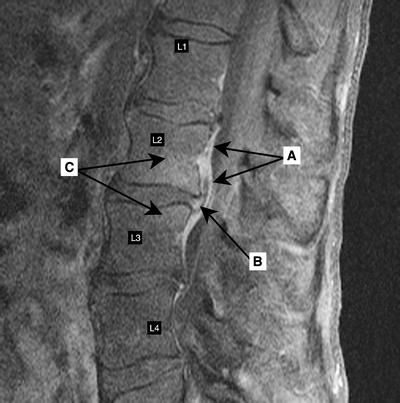 Spinal Epidural Abscess with Discitis and Vertebral Osteomyelitis ...
