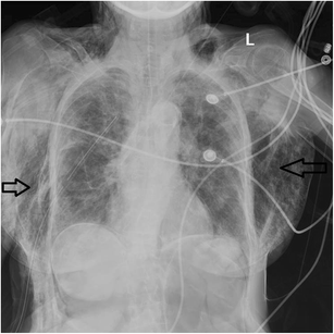 Massive Subcutaneous Emphysema | SpringerLink