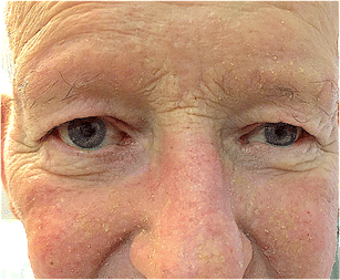 Raeder’s Paratrigeminal Syndrome: Headache and Horner’s Lacking ...