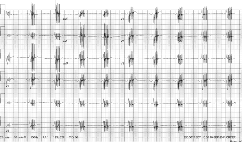 The Electrocardiogram Following Dynamic Cardiomyoplasty | SpringerLink