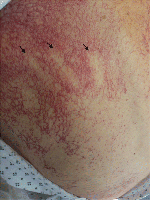 Hereditary Hemorrhagic Telangiectasia (Osler–Weber–Rendu syndrome ...