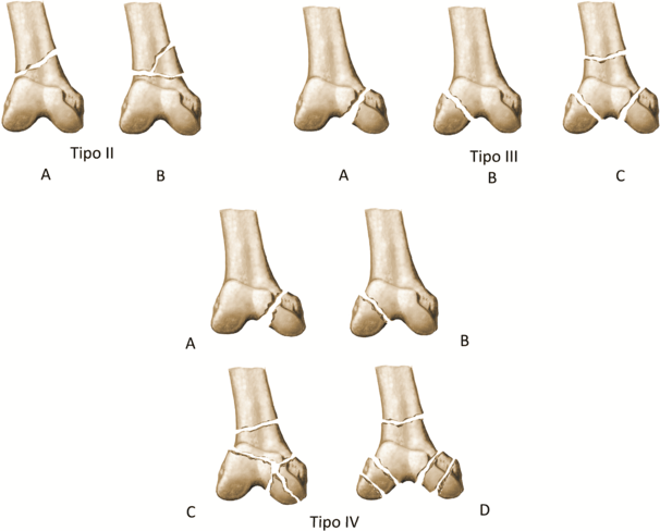 Classificazione e clinica delle fratture dell’estremo distale del ...