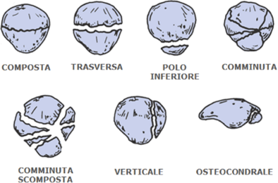 Le fratture di rotula | SpringerLink
