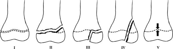 I distacchi epifisari del ginocchio | SpringerLink