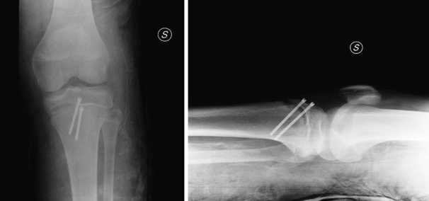 I distacchi epifisari del ginocchio | SpringerLink