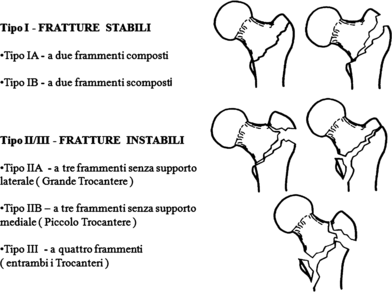L’utilizzo della protesi d’anca nel trattamento delle fratture del ...