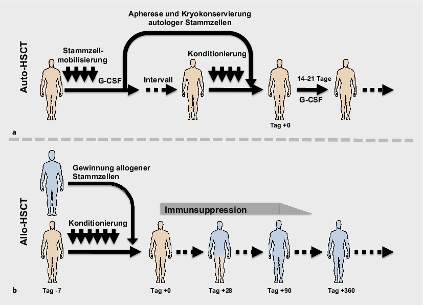 Allogene Stammzelltransplantation | SpringerLink
