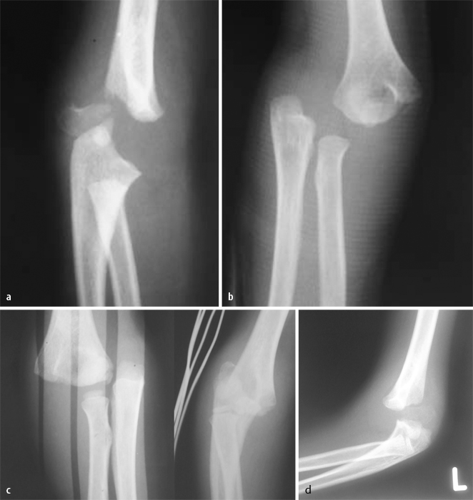 Kirschner-Draht-Osteosynthese von Frakturen des Condylus radialis im ...