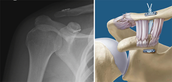 Minimalinvasive Akromioklavikulargelenk-Rekonstruktion (MINAR ...