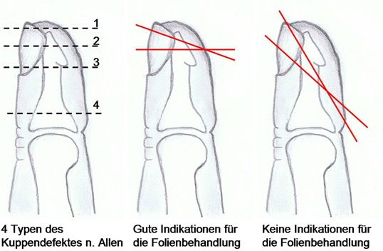 Fingerkuppendefekte | SpringerLink