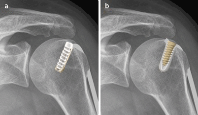 LBS-Tenotomie oder LBS-Tenodese? | SpringerLink