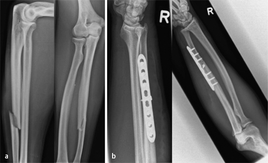 Unterarmschaftfrakturen beim Erwachsenen | SpringerLink