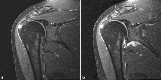 Nativ-MRT vs. MR-Arthrographie in der Diagnostik von ...