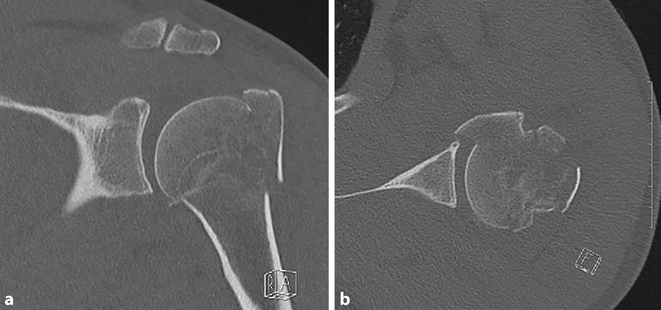 Head-split fractures of the proximal humerus | SpringerLink