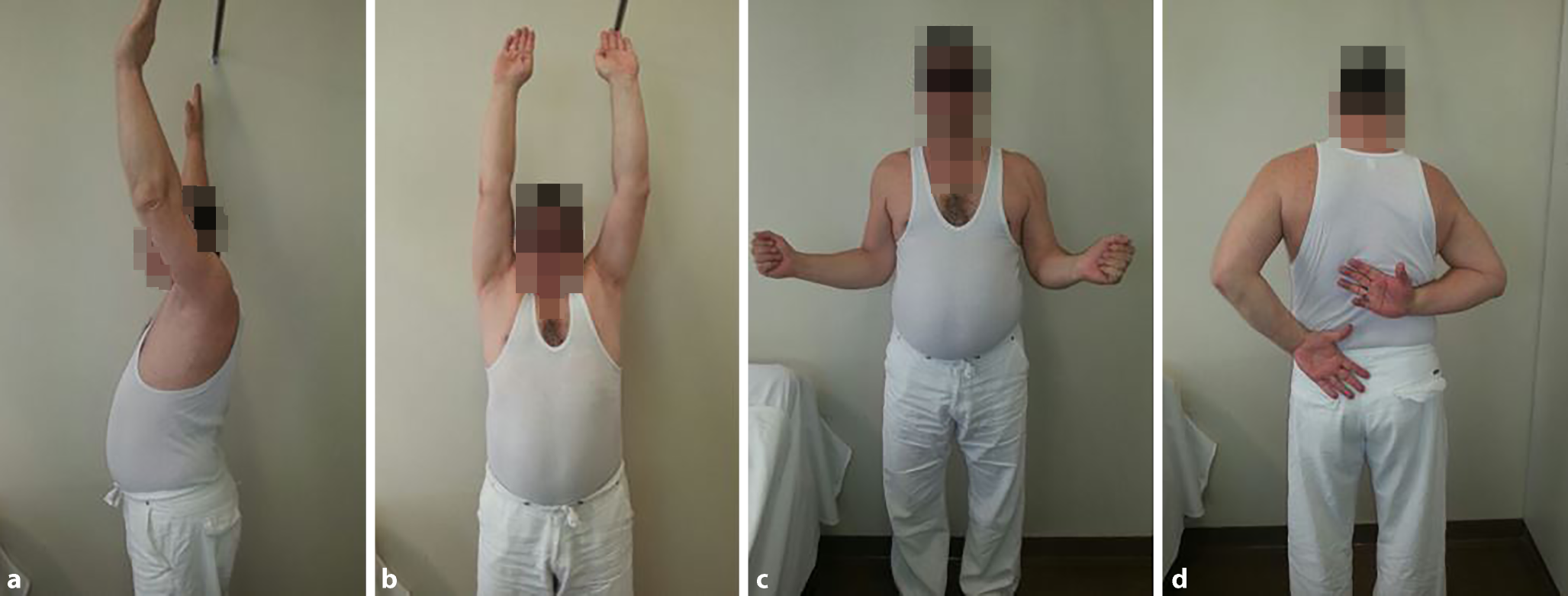 Head-split fractures of the proximal humerus | SpringerLink