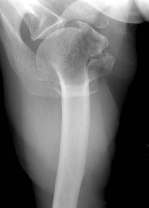 Head-split fractures of the proximal humerus | SpringerLink