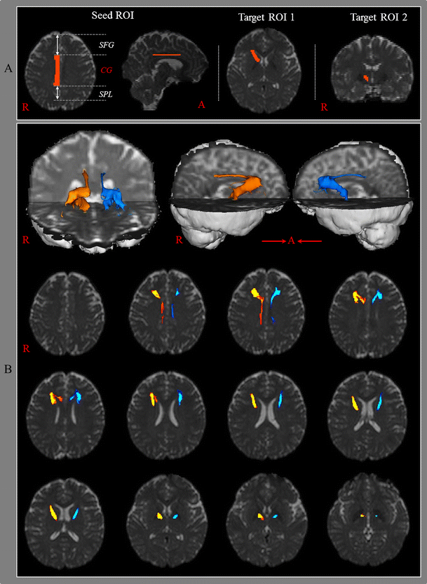 Thalamocortical tract between anterior thalamic nuclei and cingulate ...