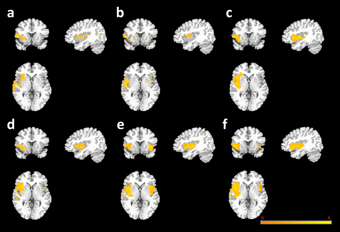 COMT-Val158Met polymorphism modulates antipsychotic effects on auditory ...