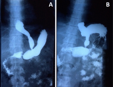 Laparoscopic Sleeve-Collis-Nissen Gastroplasty: a Safe Alternative for ...