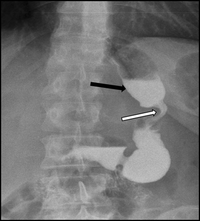 Gastric Stenosis After Laparoscopic Sleeve Gastrectomy: Diagnosis and ...