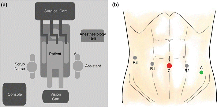 Robotic transverse colectomy for mid-transverse colon cancer: surgical techniques and oncologic ...