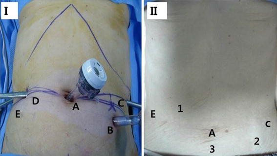 Simultaneous robotic subtotal gastrectomy and right hemicolectomy for ...