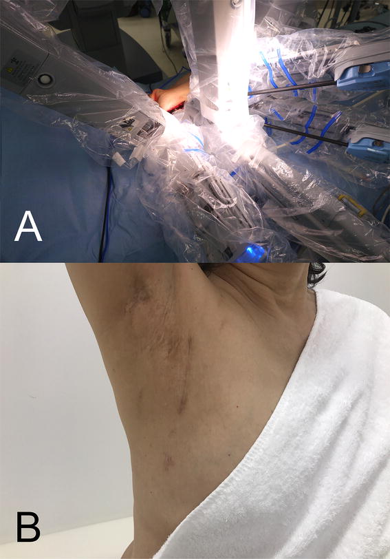 A single-incision thoracoscopic and robotic hybrid procedure via the ...
