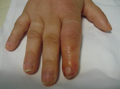 Endocarditis with pulmonary and systemic embolization | SpringerLink