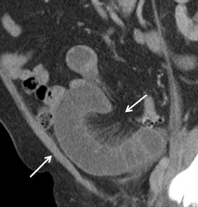 Classic signs of closed loop bowel obstruction | SpringerLink