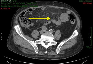 The chance case history of an unusual disease: mesenteric panniculitis ...
