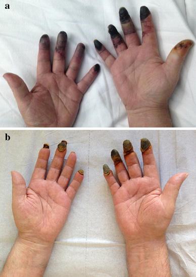 Severe digital necrosis as the clinical onset of antiphospholipid ...